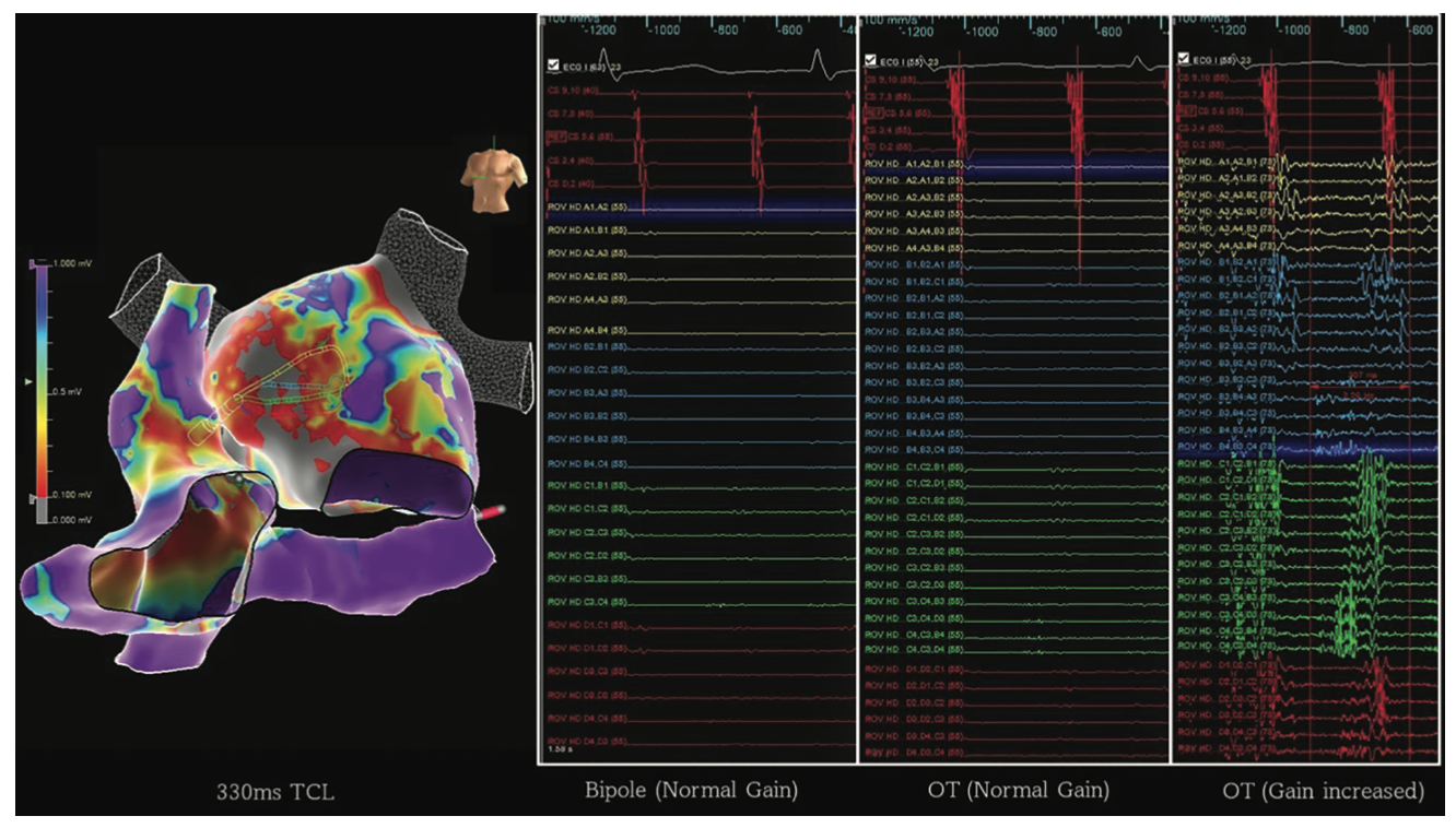 Novel High Density Mapping Techniques For Atypical Atrial Flutter